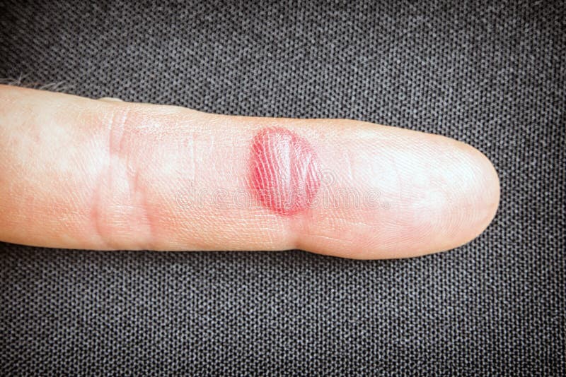 Bloody abrasion on finger stock image. Image of hand - 84285183