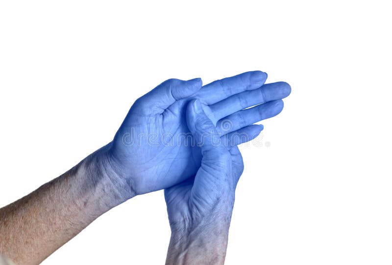 Blue Colored Hand of Asian Man. Concept of Cold and Clumsy Hand Stock ...