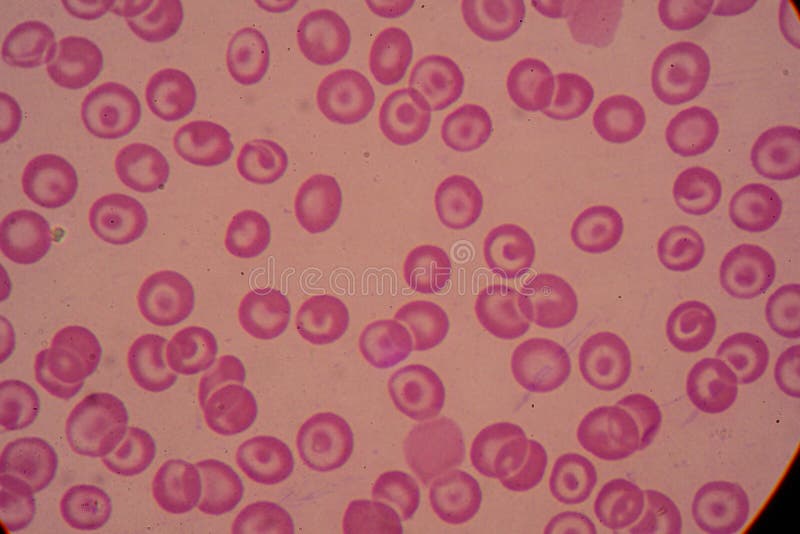 Der Blutausstrich, Der Unter Mikroskop WBC Darstellt, Ist Atpical ...