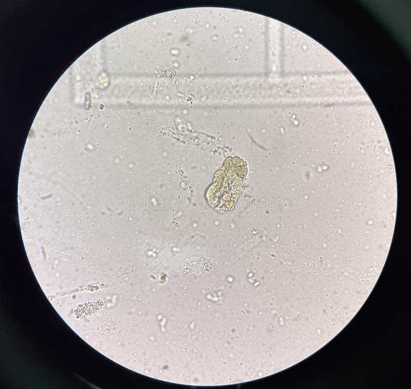 Cast in Fresh Urine Finding with Microscope Stock Photo - Image of ...