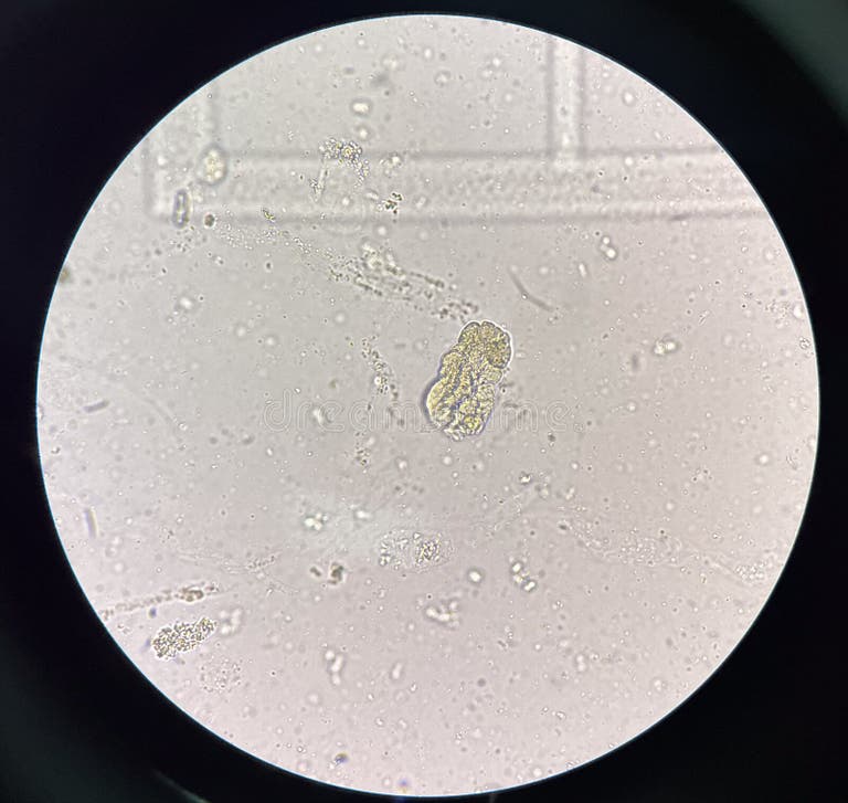 Cast in Fresh Urine Finding with Microscope Stock Photo - Image of ...