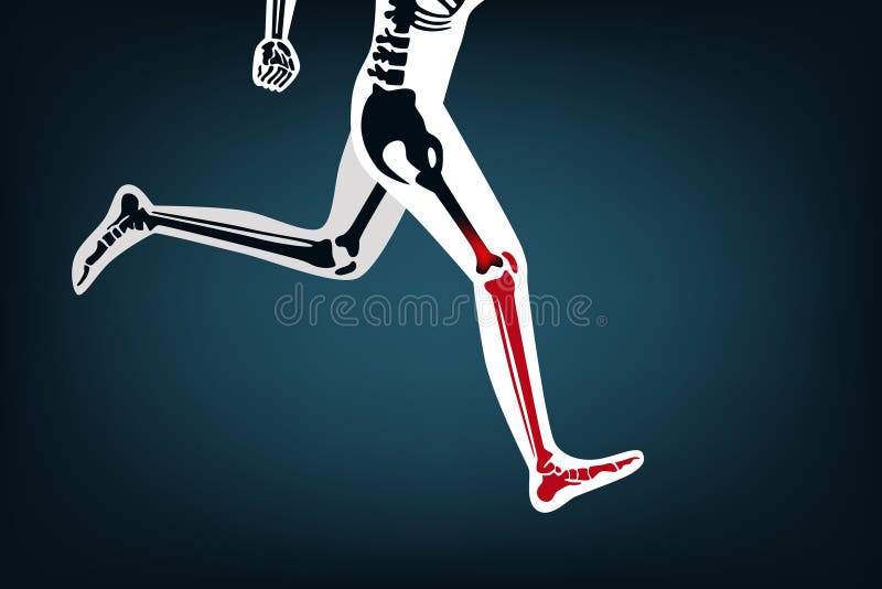 Leg pain, bone pain stock illustration. Illustration of isolated ...