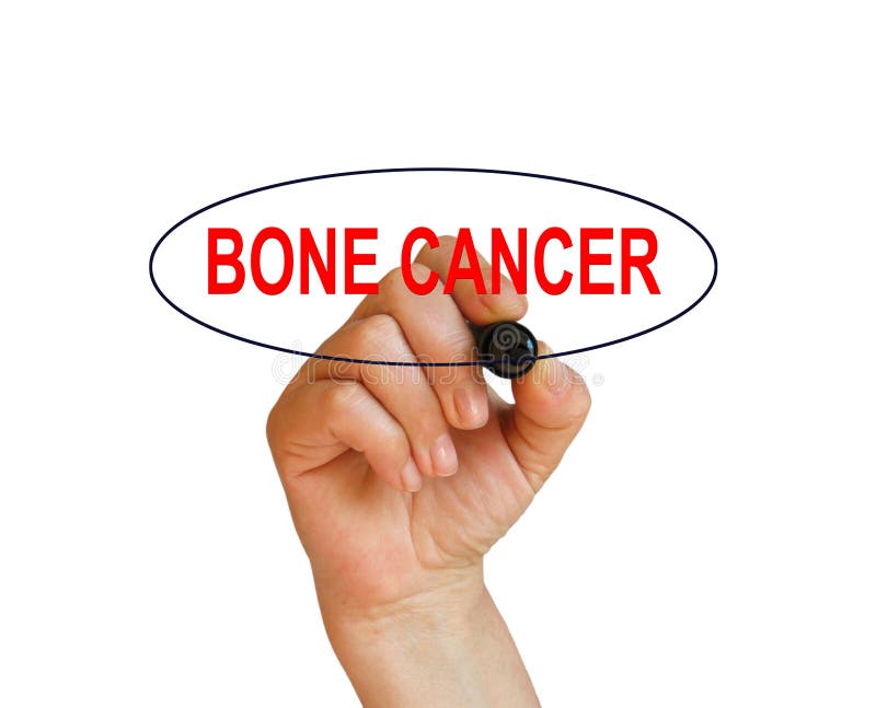 Bone Cancer Color Line Icon. Malignant Neoplasm. Oncology. Isolated ...