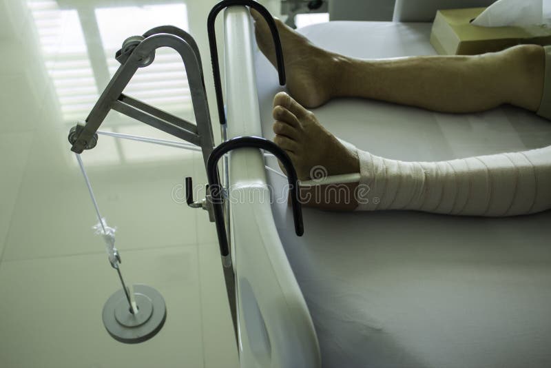 Bone fracture stock image. Image of healthcare, adult - 54626187