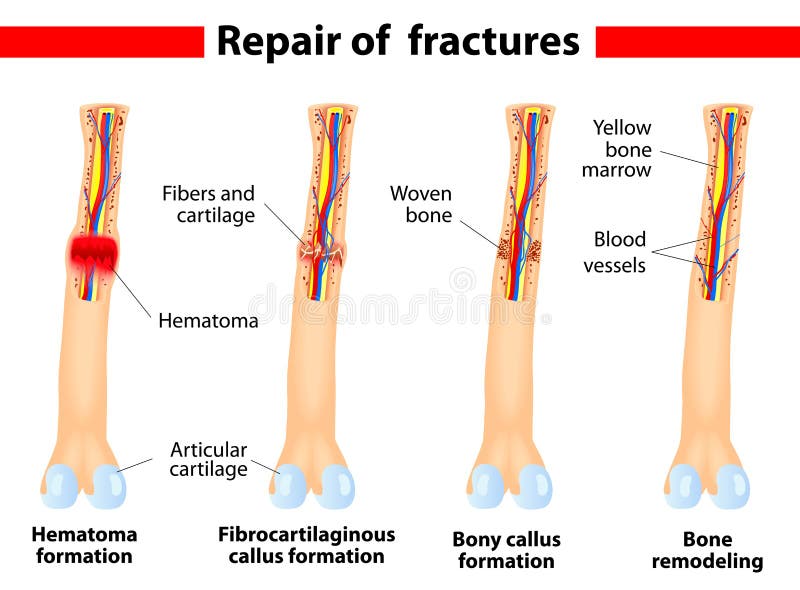 Bone Fracture Healing Process Stock Vector - Illustration of arthritis ...