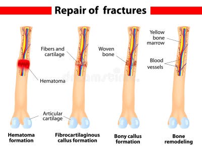 Bone Fracture Healing Process Stock Vector - Illustration of arthritis ...