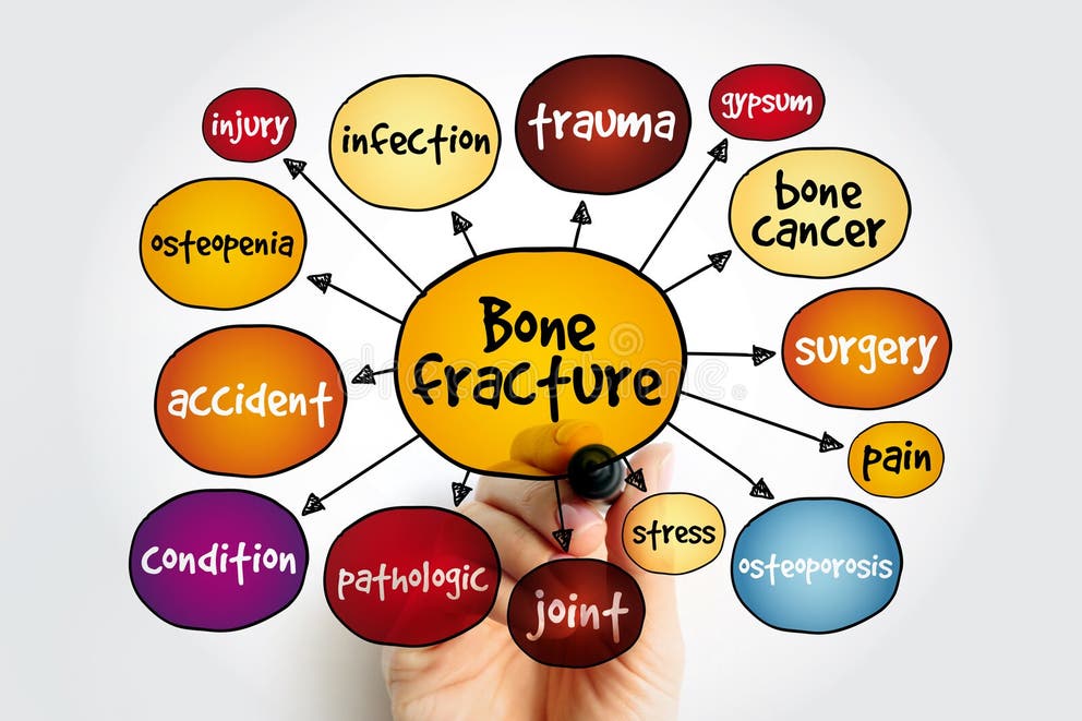 Bone Fracture Mind Map, Concept for Presentations and Reports Stock ...