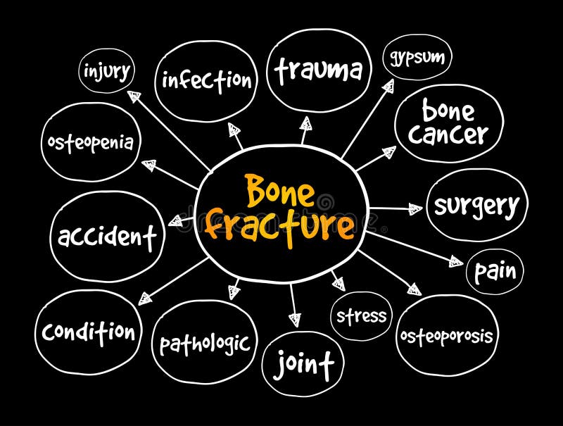 Bone Fracture Mind Map, Concept for Presentations and Reports Stock ...