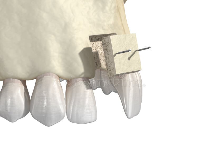 Bone Grafting- Augmentation Using Block of Bone, Tooth Implantation ...