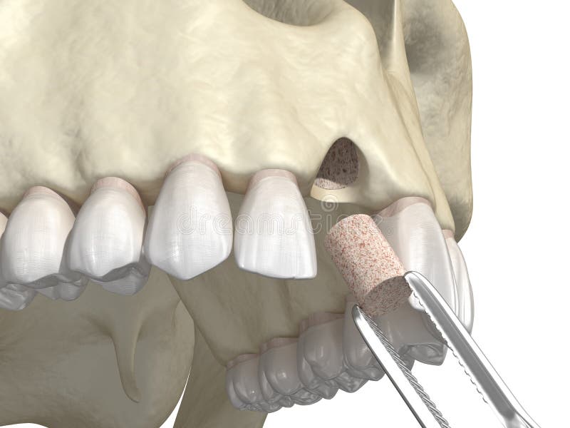 Bone Grafting- Augmentation Using Ring Method, Tooth Implantation ...