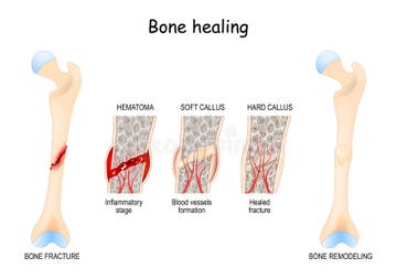 Bone Remodeling Process Stock Illustrations – 79 Bone Remodeling ...