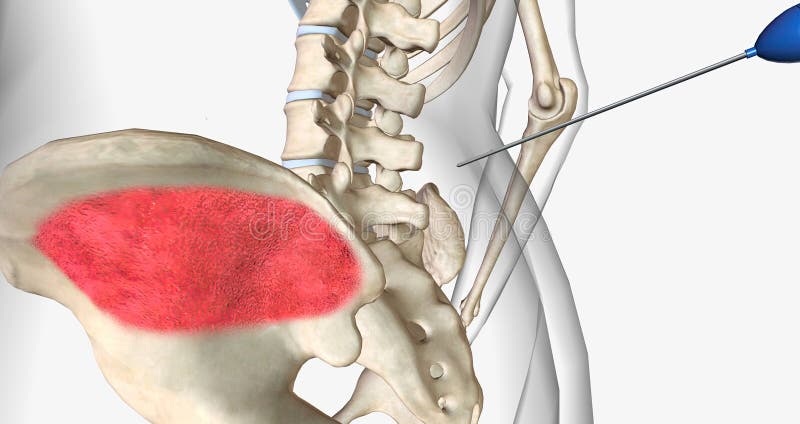 Bone Marrow Aspiration is a Procedure in Which a Liquid Bone Marrow ...