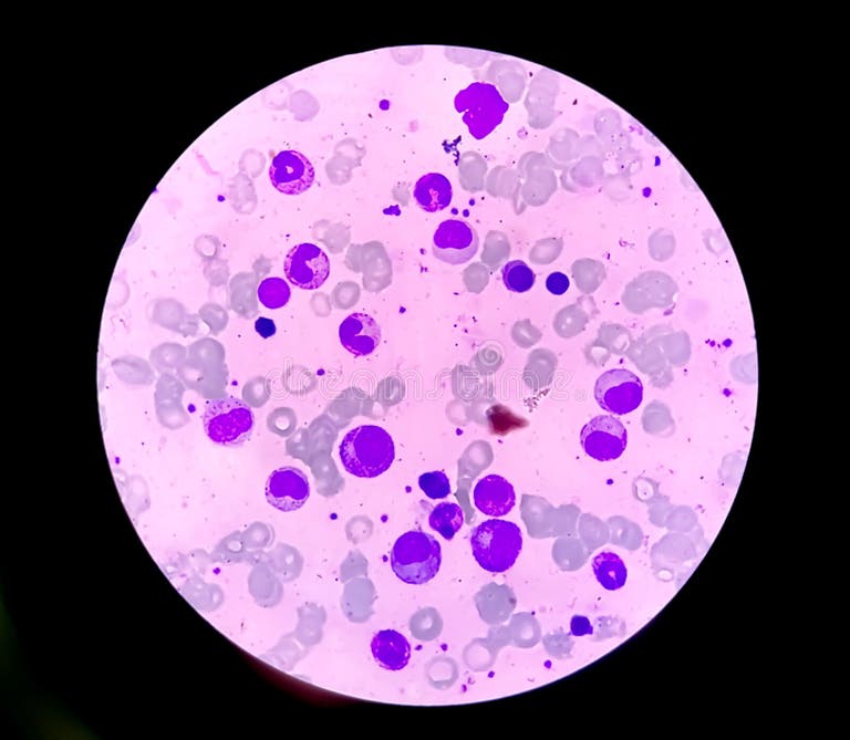 Bone Marrow Study: Dimorphic Erythroid Hyperplasia Stock Image - Image ...