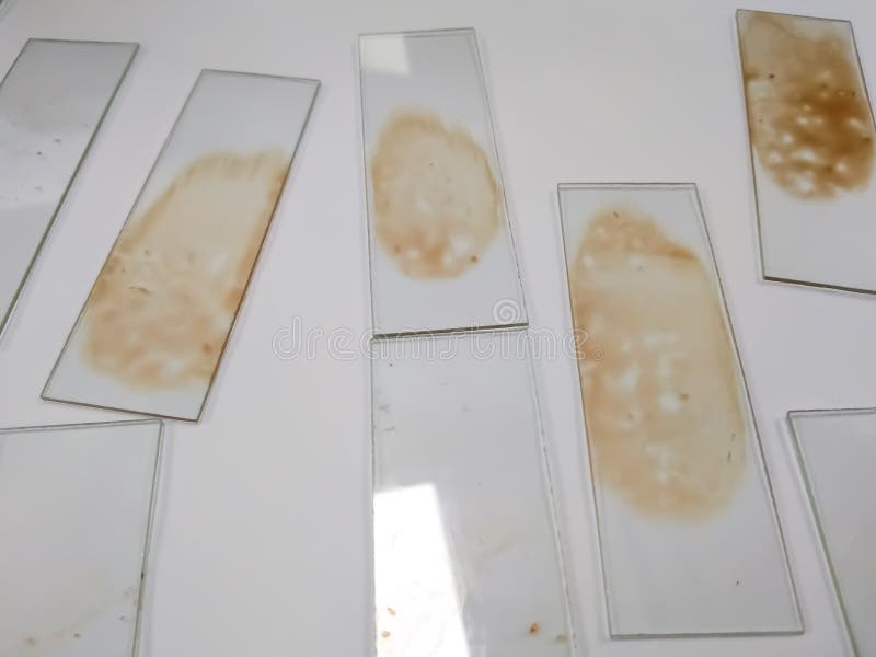 Bone Marrow Study. Microscopic Glass Slide Smear Stock Photo - Image of ...