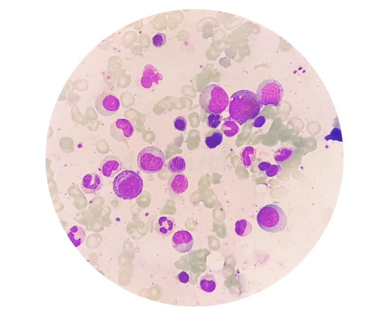 Bone Marrow Study: Suggestive of Reactive Marrow with Dimorphic ...