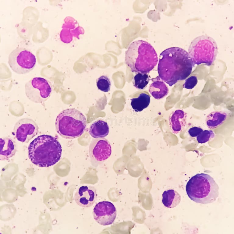 Bone Marrow Study : Dimorphic Erythroid Hyperplasia Stock Photo - Image ...