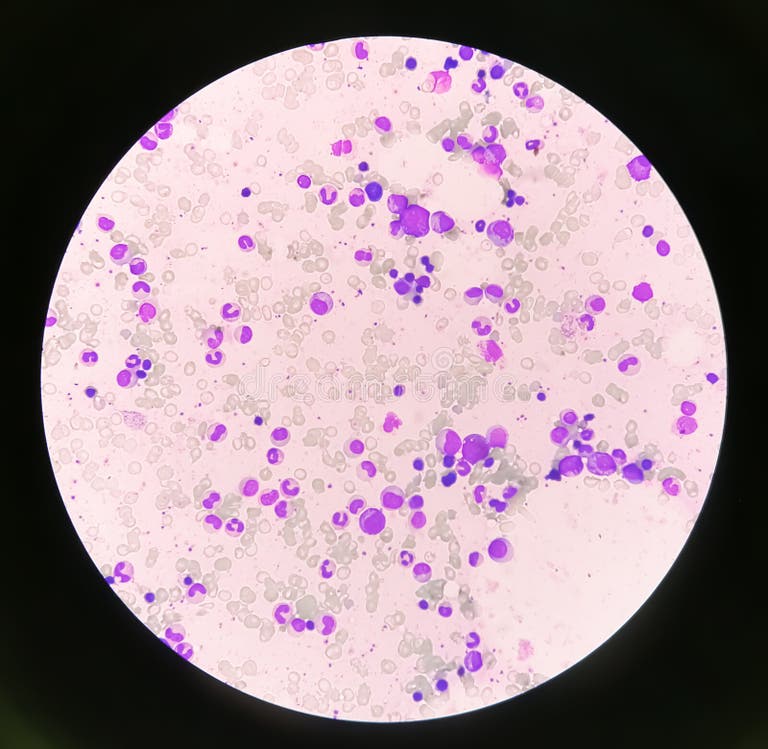 Bone Marrow Study: Suggestive of Reactive Marrow with Dimorphic ...