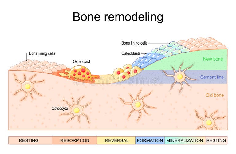 Bone Remodeling Process Stock Illustrations – 83 Bone Remodeling ...