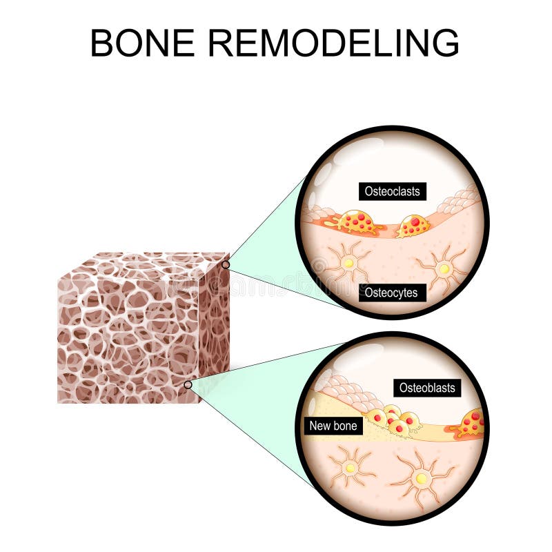Bone Remodeling from Resorption To New Bone Formation Stock Vector ...