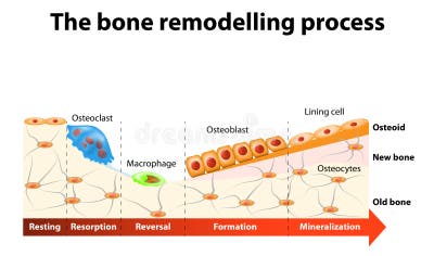 Bone remodelling process stock vector. Illustration of cells - 61582324
