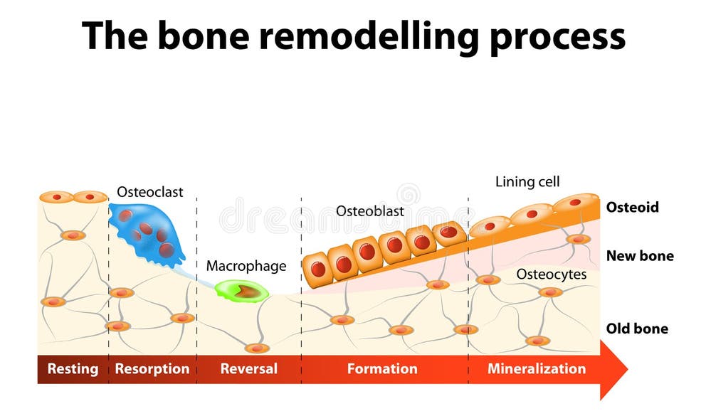 Bone remodelling process stock vector. Illustration of cells - 61582324