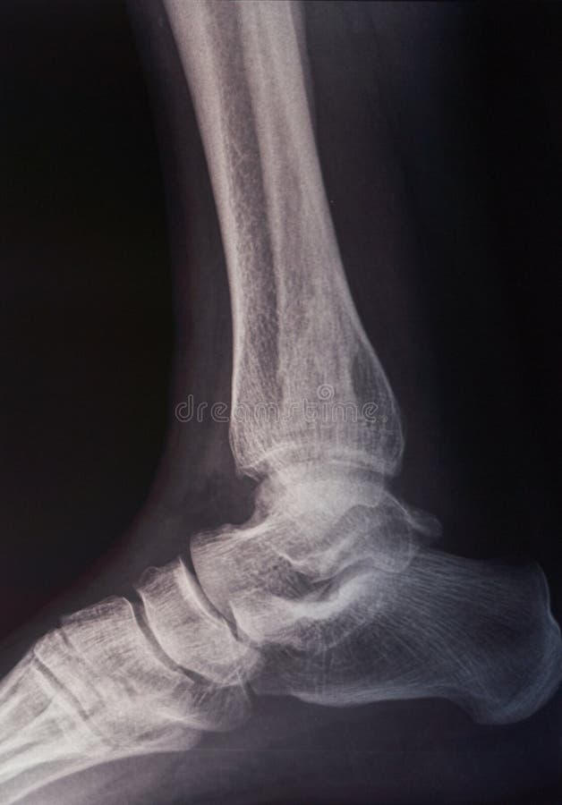 Bone scan of a foot stock photo. Image of physical, joint - 185659906