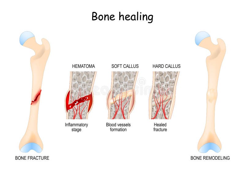 Hematoom Stadia Geïsoleerde Vector Illustratie - Illustration of ...