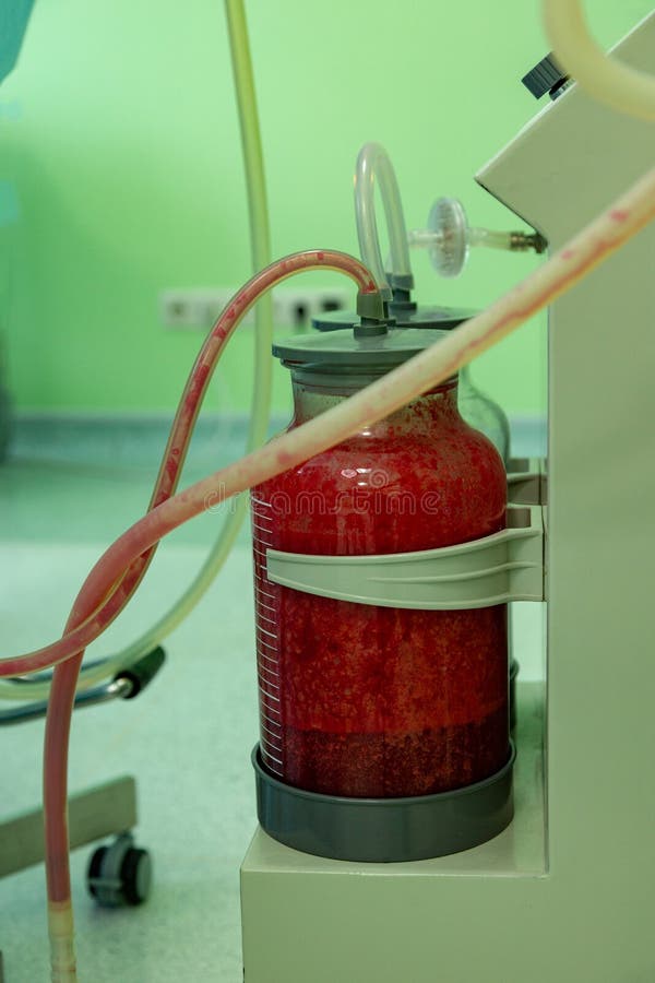 The Bottles for the Fat Liquid from Liposuction Stock Photo - Image of ...