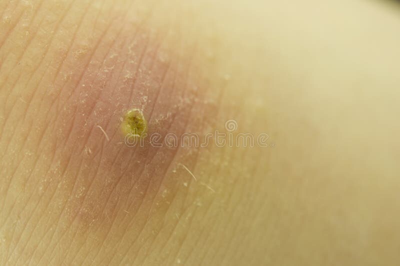Un Bouton Sur La Peau D'un Homme De Couleur Claire Photo stock - Image ...