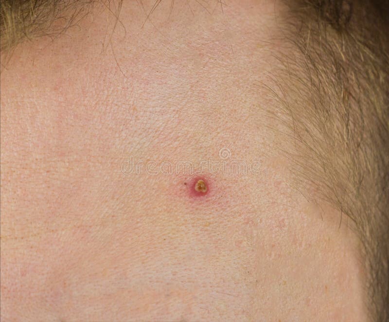 Bouton Sur Le Pied Masculin, Macro Photographie, Pustule Photo stock ...