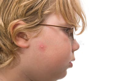 376 Boy Face Pimple Spot Acne Stock Photos - Free & Royalty-Free Stock ...
