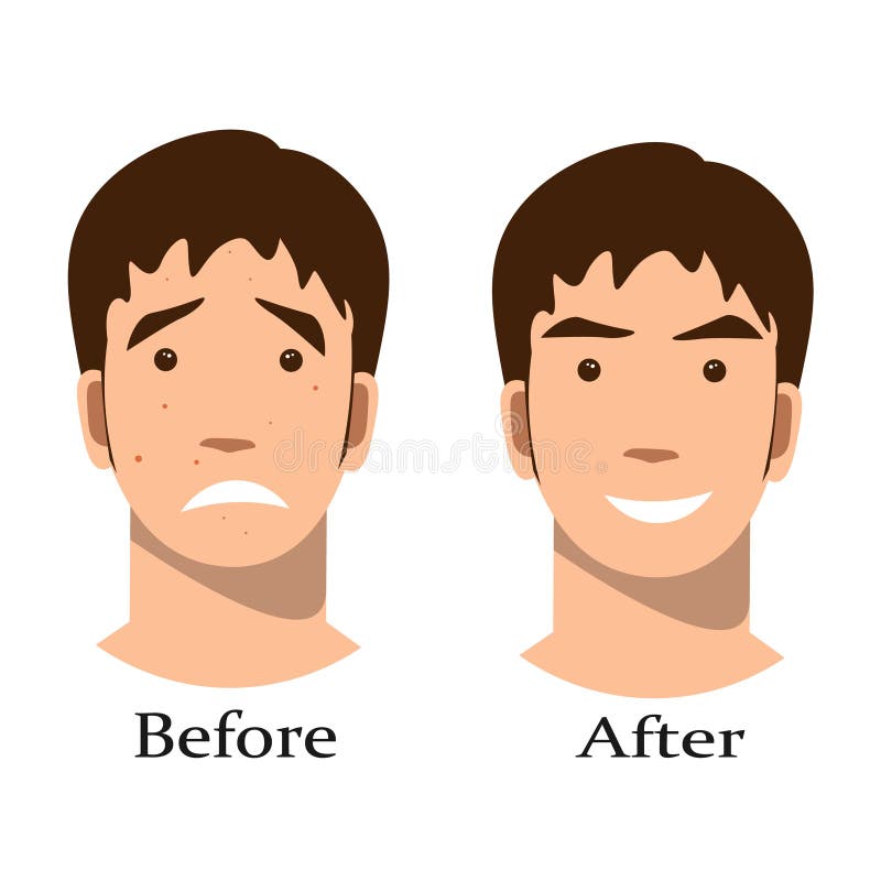 Acne Boy Stock Illustrations – 429 Acne Boy Stock Illustrations ...