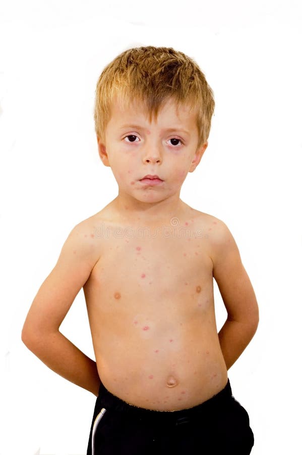 Boy with chicken pox stock photo. Image of illness, disease - 6719190