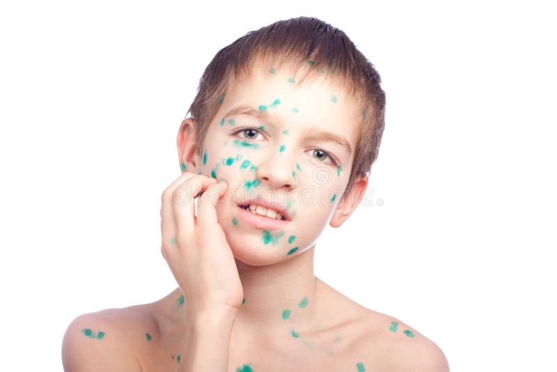 859 Boy Smallpox Stock Photos - Free & Royalty-Free Stock Photos from ...
