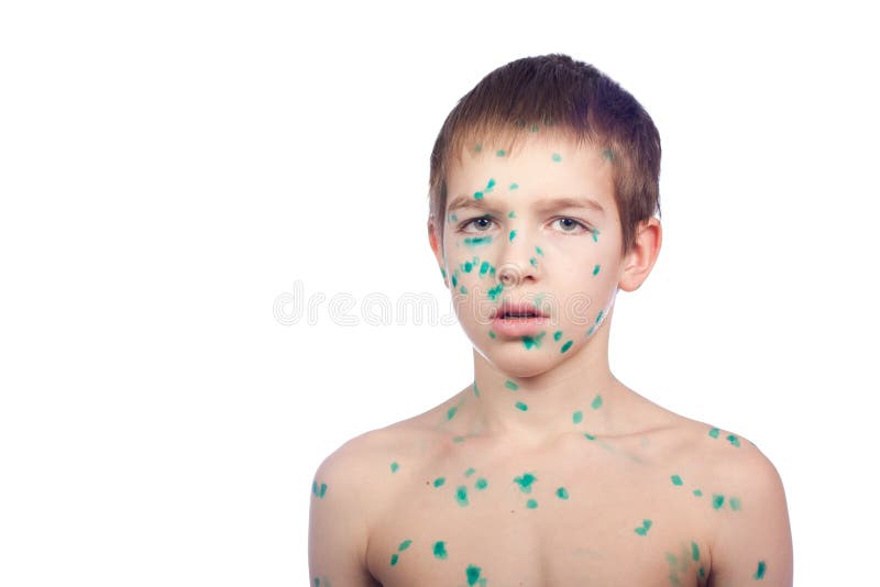 859 Boy Smallpox Stock Photos - Free & Royalty-Free Stock Photos from ...