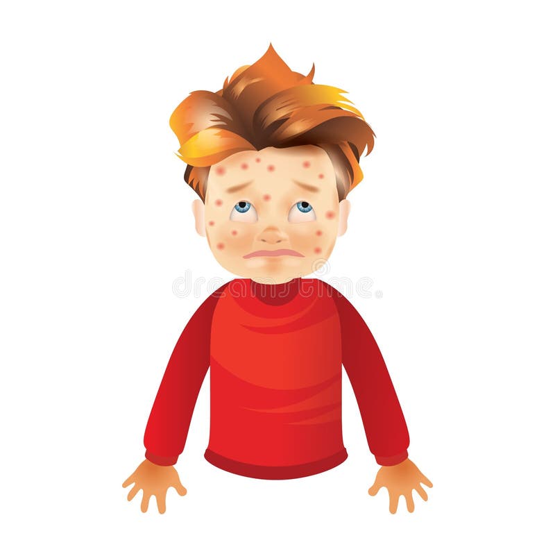 Chickenpox Stock Illustrations – 735 Chickenpox Stock Illustrations ...