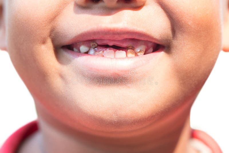 The Boy with Decayed Baby Teeth. Stock Image - Image of milk, dental ...