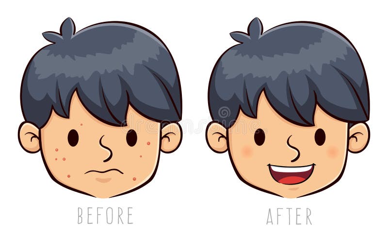 Boy Face with Acne Problem before and after Stock Vector - Illustration ...