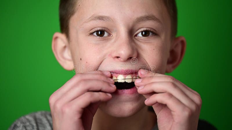 Alignment of Teeth, Twisting of a Plate by Means of a Special Key, Care ...