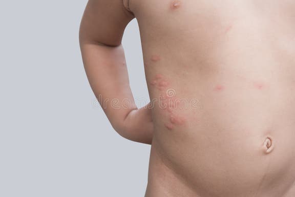 Boy with Multiple and Insect Bites on Body Stock Photo - Image of bite ...