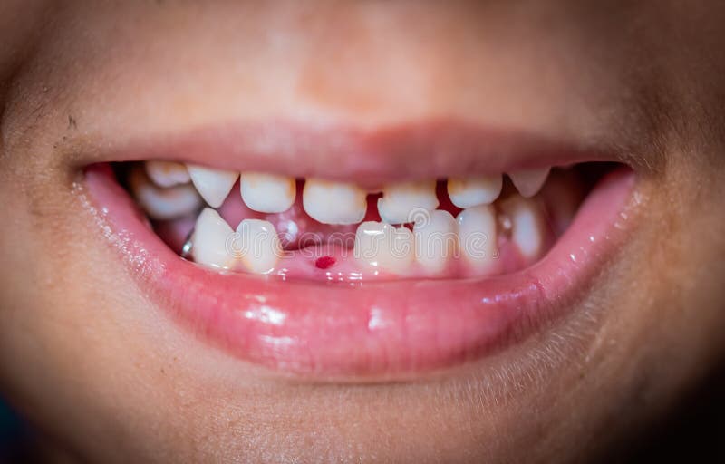 Boy with Missing Teeth Smile To Show His Missing Teeth Stock Image ...