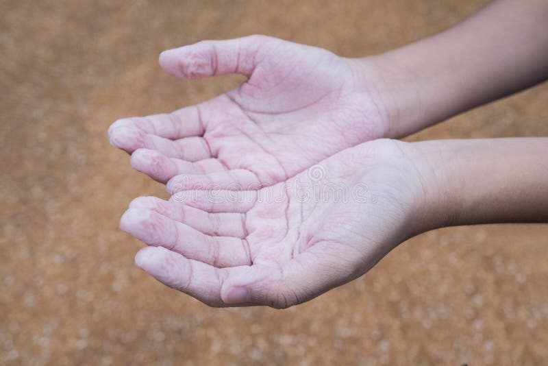 Boy Open Withered Skin Hands Stock Image - Image of healthcare ...