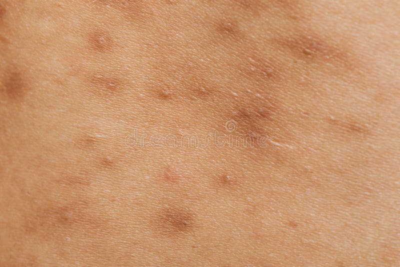 Boy Problematic Skin Acne Scars Back Stock Photos - Free & Royalty-Free ...