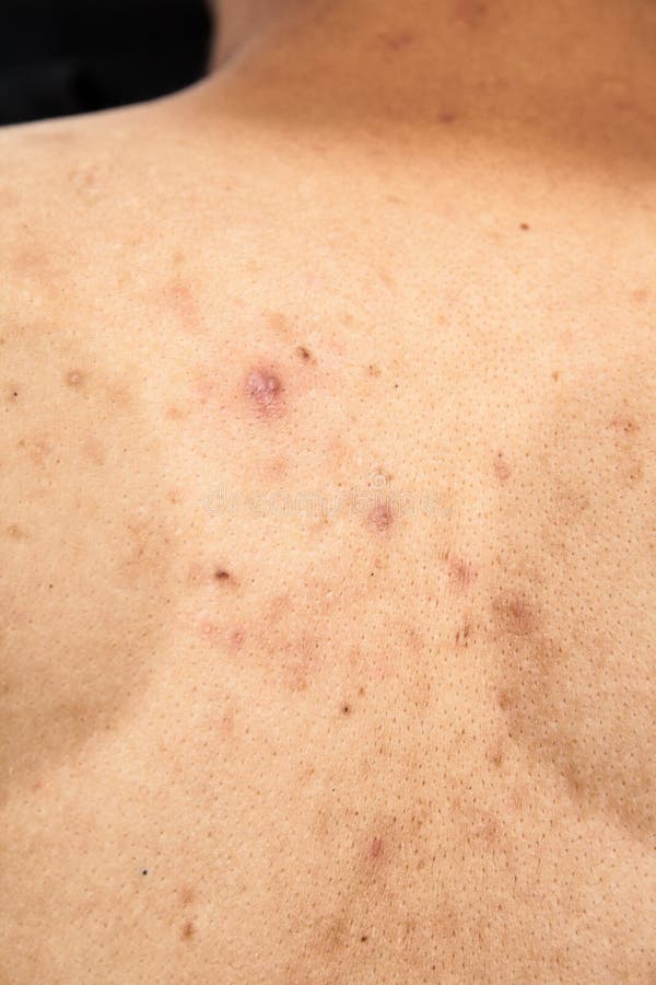 Boy with Problematic Skin and Acne Scars Stock Image - Image of medical ...