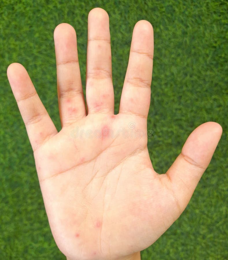 A Boy& X27;s Hand with Boils in Several Parts Stock Photo - Image of ...