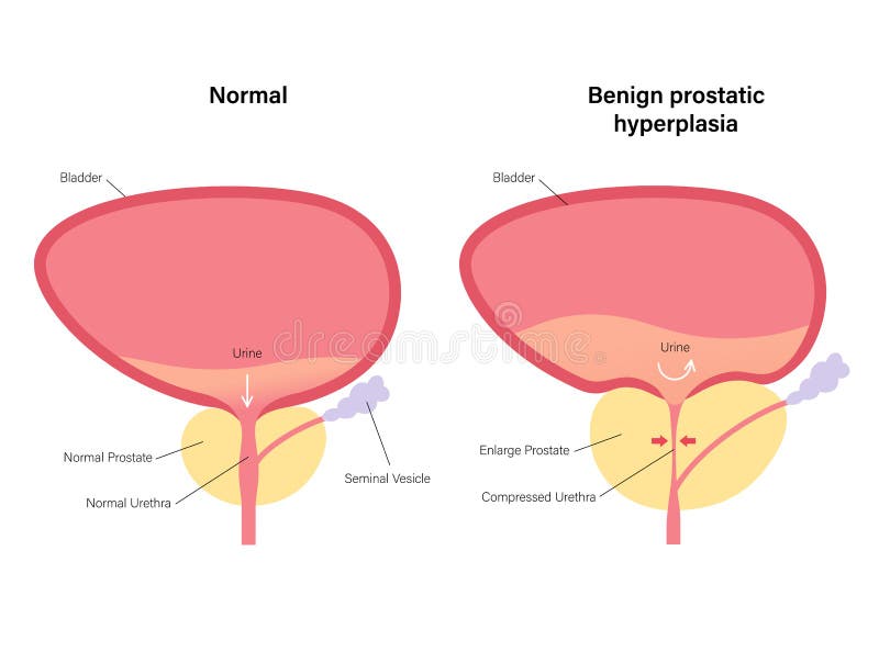 BPH info concept stock illustration. Illustration of enlargement ...
