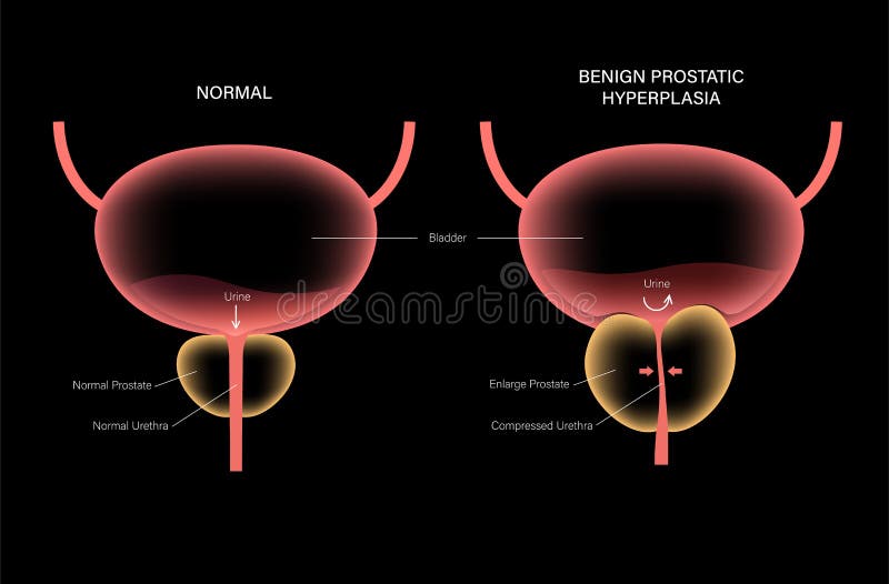 BPH info concept stock illustration. Illustration of enlargement ...