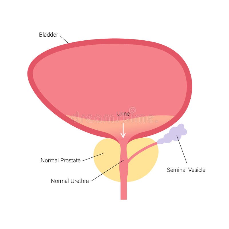 BPH info concept stock illustration. Illustration of enlargement ...