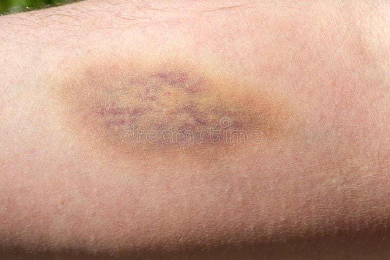 Equimose imagem de stock. Imagem de doloroso, pele, humano - 30516979