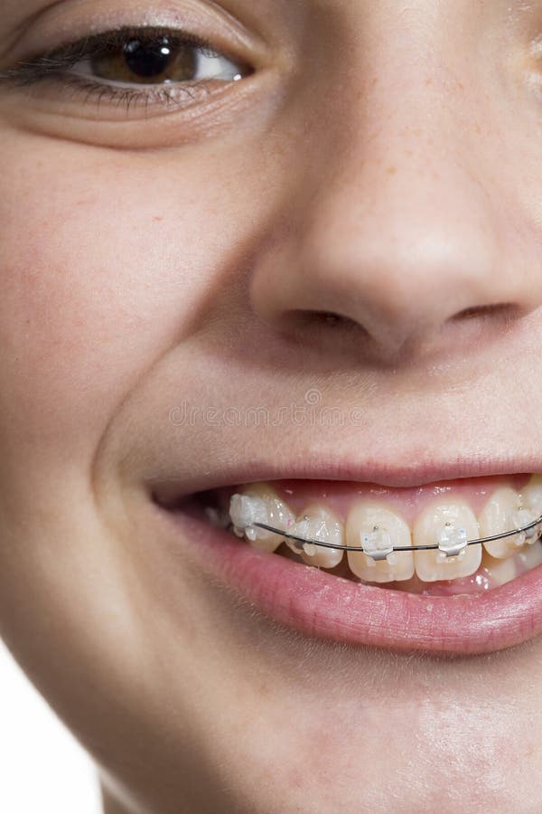 Brace stock image. Image of medical, equipment, lips - 72485435